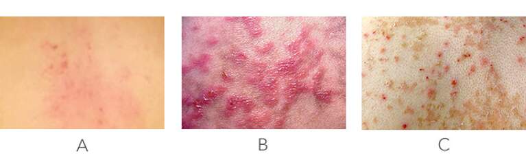 Keto Rash: What is it, and How Can it Be Resolved? | KetoDiet Blog